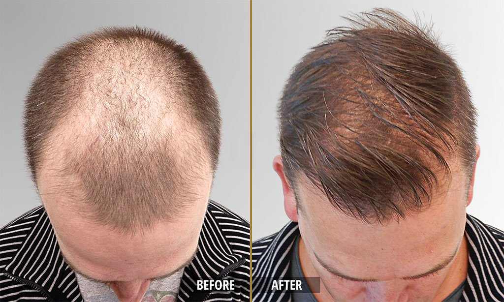 Deliiston Anti-Hair Loss Shampoo