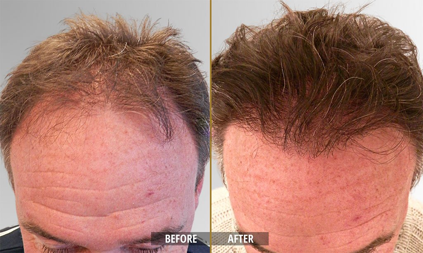 Deliiston Anti-Hair Loss Shampoo