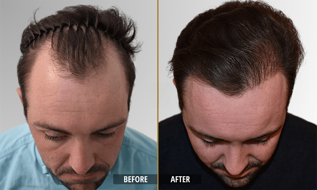 Deliiston Anti-Hair Loss Shampoo